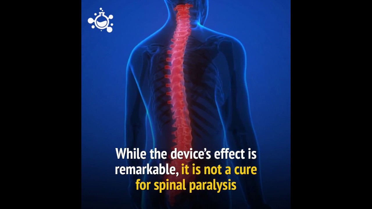 Spinal Implant Restores Walking In Paralyzed Patients Youtube