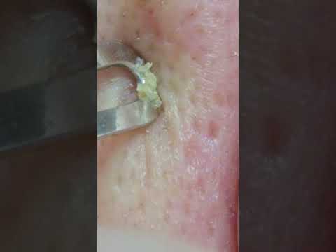 acne, pimple and sebum popping by myself #10 #acne #pimple # ...