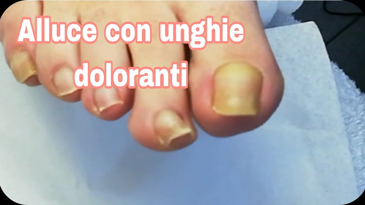 Dolore alle unghie dell'alluce🤕#ArmoniaDonna #dolore #alluci - YouTube