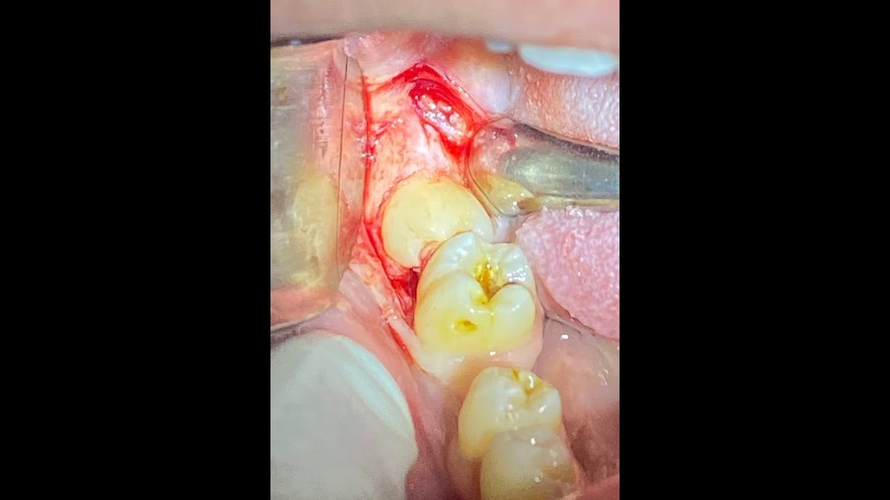 odontectomy of lower right impacted wisdom - YouTube