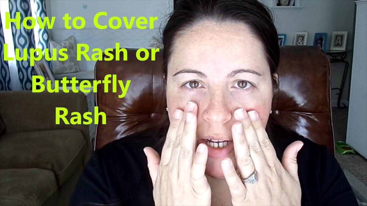 How to Cover Lupus Butterfly Rash or Molar Rash - YouTube