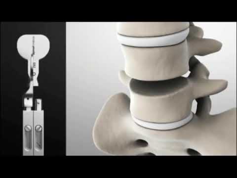 M6 Disc Replacement M6-L Lumbar Artificial Disc Replacement - YouTube