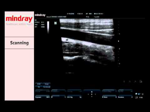 Mindray M7 - YouTube