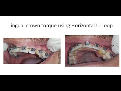 Orthodontic TORQUE Control of Tooth | Brackets | Braces | Rectangular ...