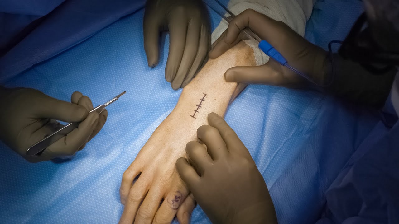 Scaphoid Fracture Open Reduction & Internal Fixation: Dorsal Approach ...