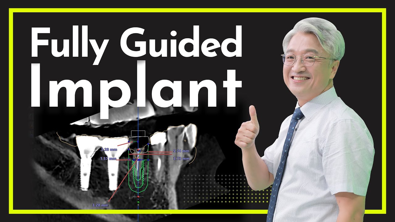 [DIGITAL DENTISTRY] Fully Guided Implant - YouTube