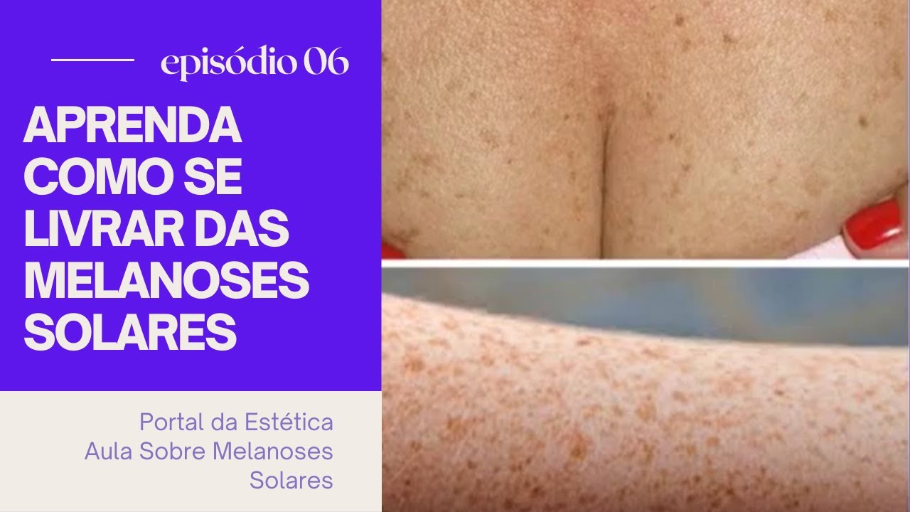 [Aula] Tudo sobre Melanoses Solares e Seus Tratamentos - YouTube