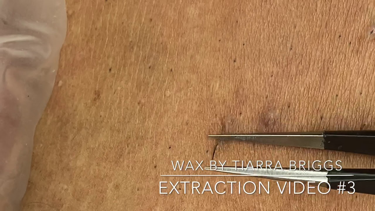 Ingrown hairs extraction - YouTube
