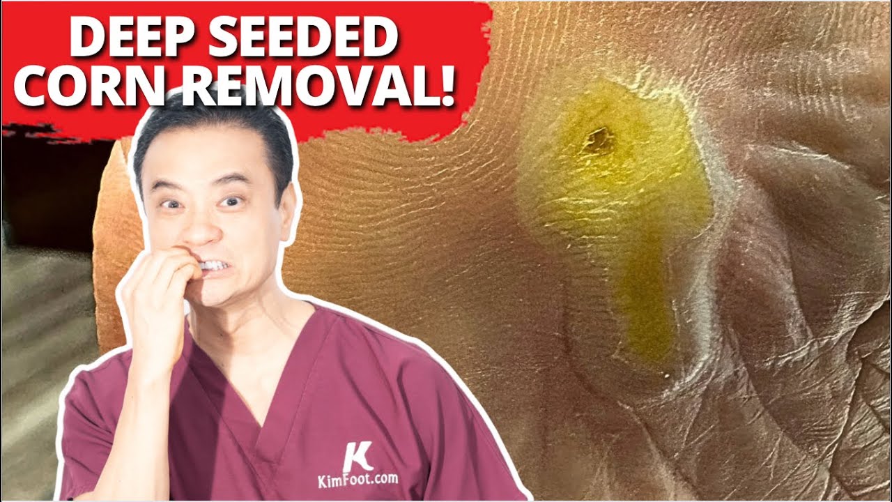 DEEP Seeded Corn Removal! (MUST WATCH) - YouTube