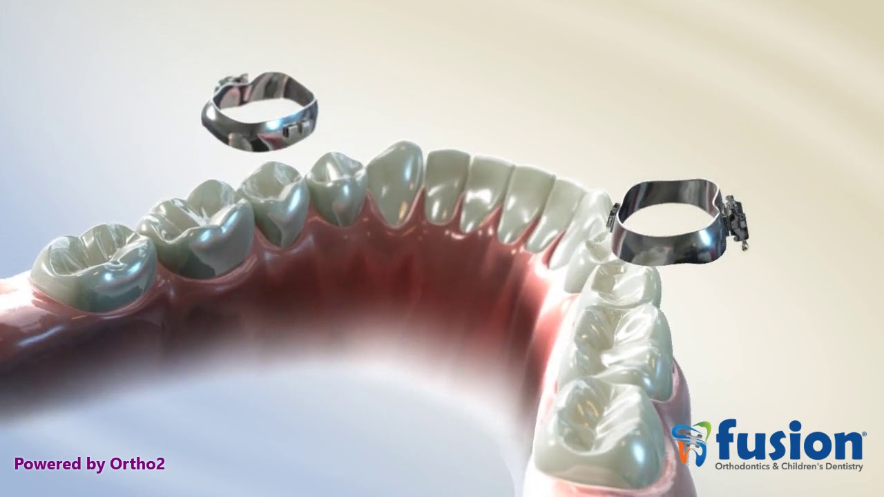 Wilson Bimetric Distalizing Arch - YouTube