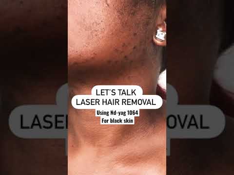 Laser hair removal for black skin using ND-yag 1064nm |Fotona Laser