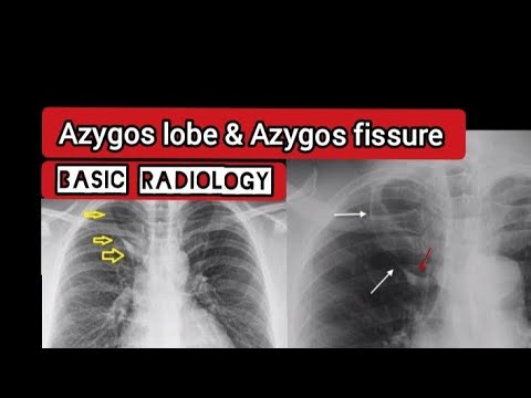 Azygos lobe & Azygos fissure - Basic Radiology - YouTube
