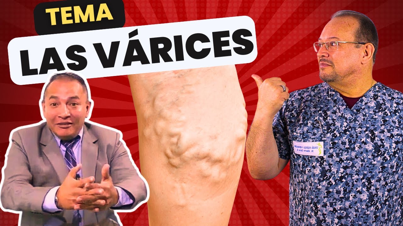 ¿Qué Causa las Varices y Cómo Prevenirlas? DR ALBERTO CALVO 👨‍⚕️ DR ...