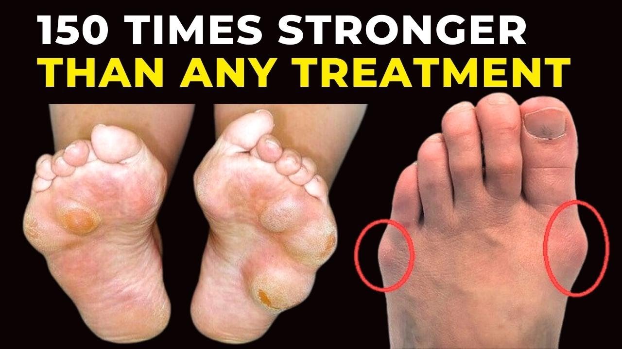 This will loosen the bump in the foot and straighten the protruding ...