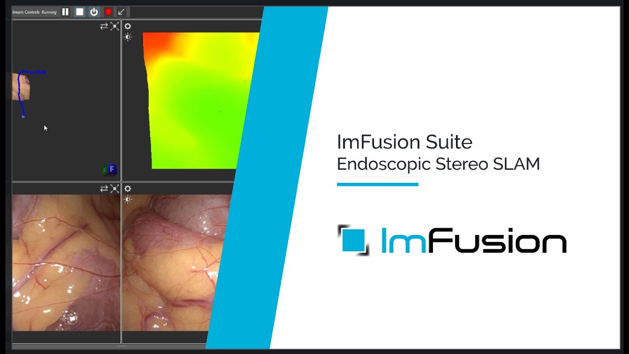 ImFusion Suite's endoscopic SLAM pipeline on stereoscopic video of laparoscopic screening ...