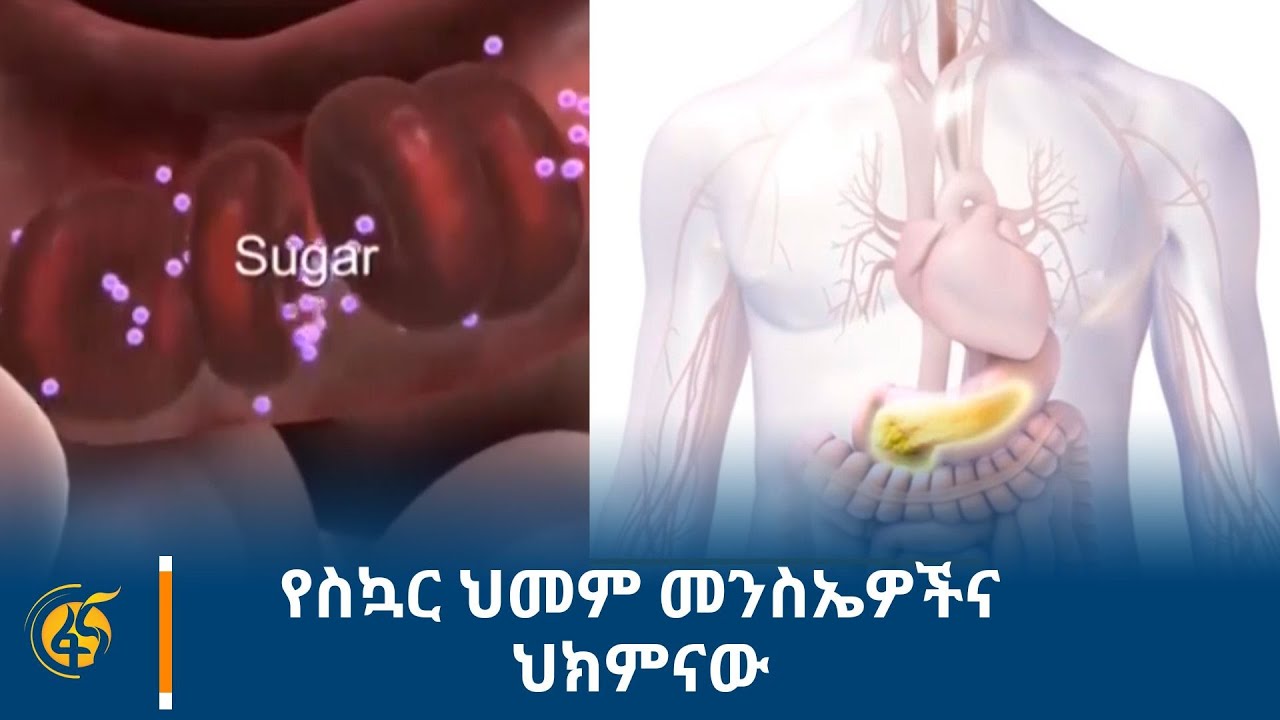 የስኳር ህመም መንስኤዎችና ህክምናው Youtube