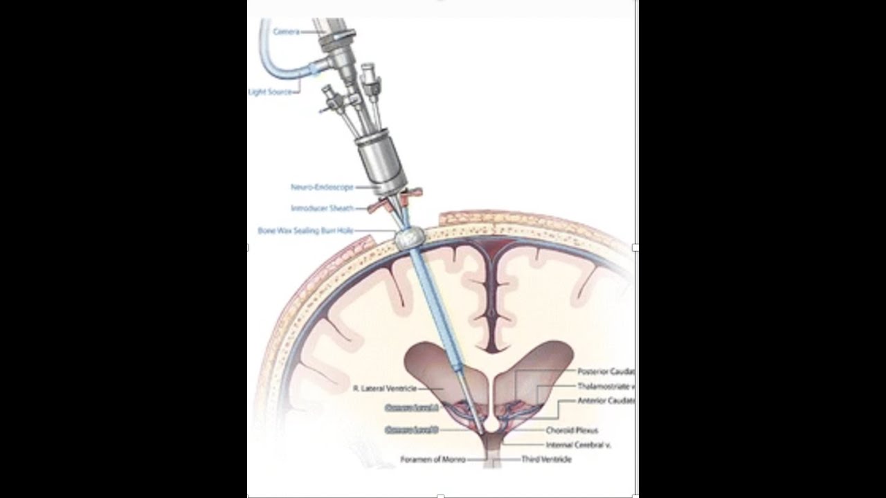 ENDOSCOPIC EVACUATION OF CHRONIC SUBDURAL HEMATOMA ( DR ANAND SHARMA ...