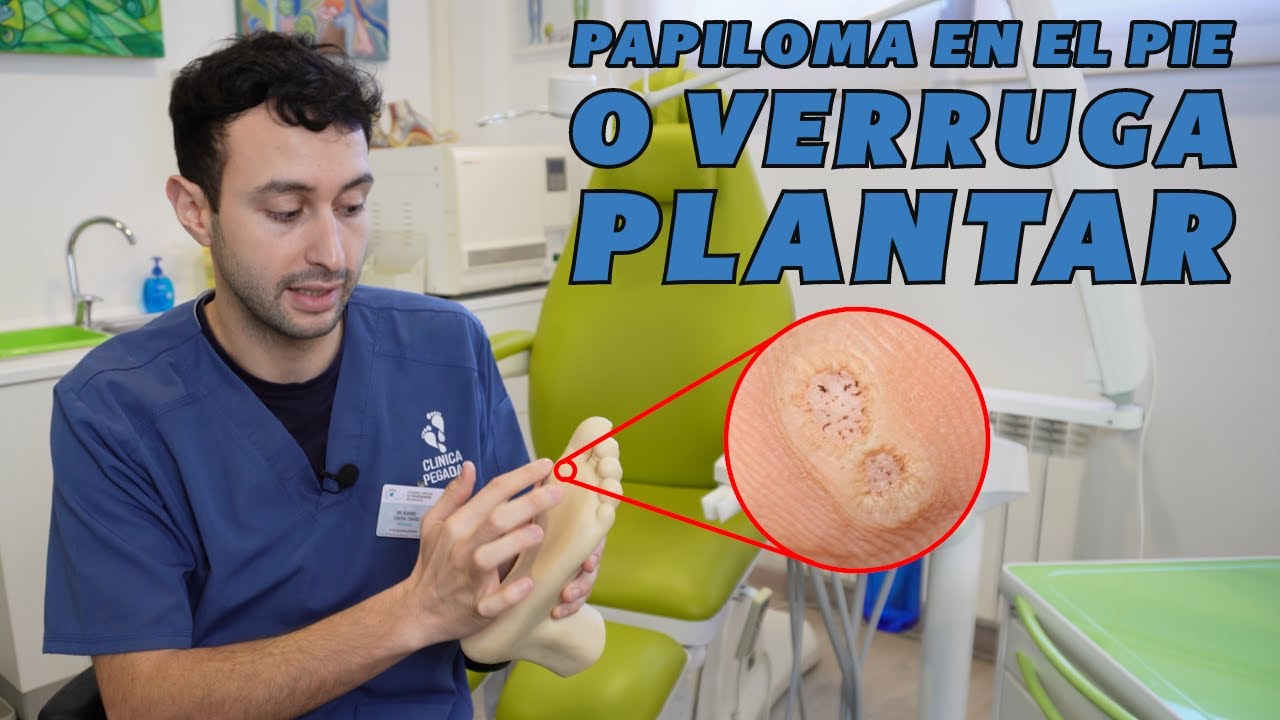 Papiloma en el pie o verruga plantar - Tipología, tratamiento y ...