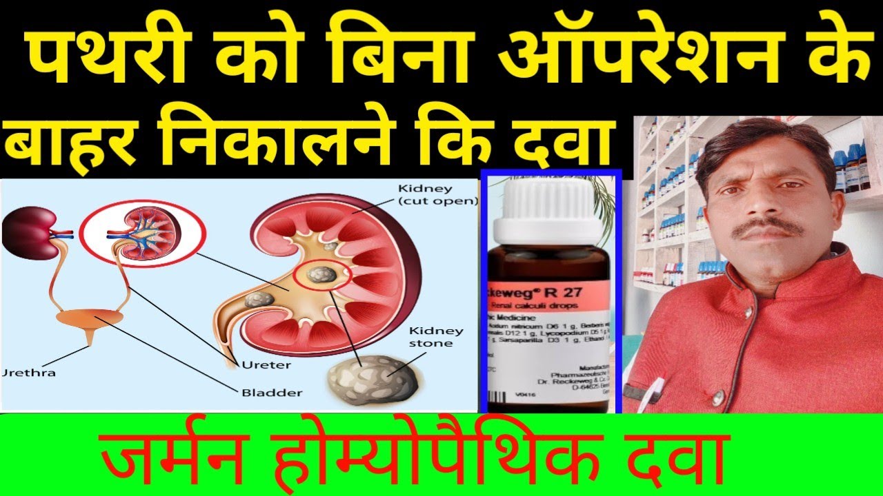 pathri ka ilaj | pathri ki dawai | Pathri ke lakshan | Kidney Stone ...