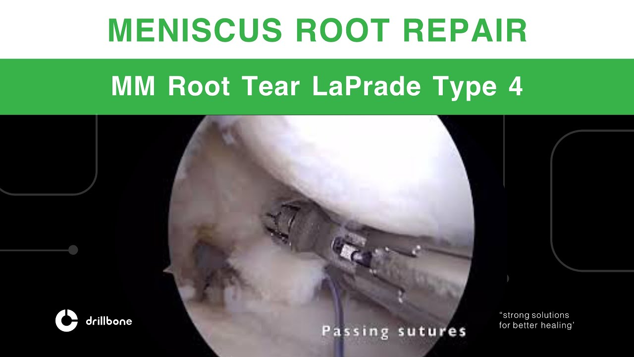 Medial Meniscus Root Repair [OBLIQUE TEAR INTO ROOT ATTACHMENT] - YouTube