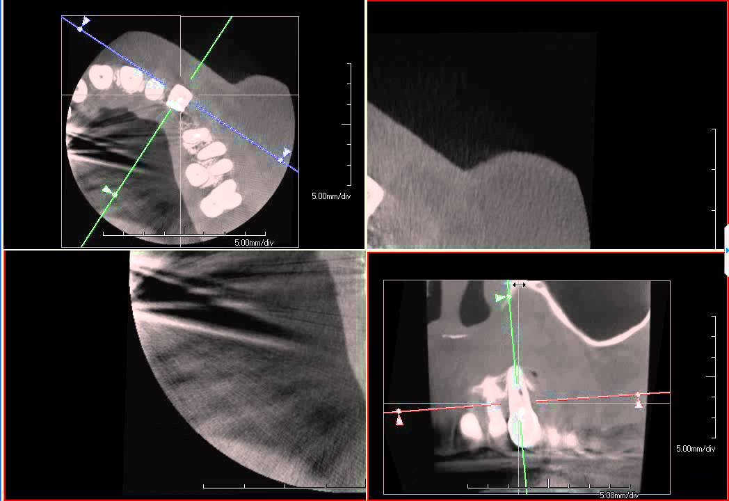 Pesquisa Canal Atrésico (Tomógrafo Prexion) - YouTube