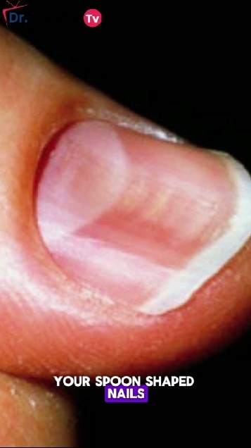 Koilonychia (Spoon Nails): Causes, Symptoms & Treatments! - YouTube