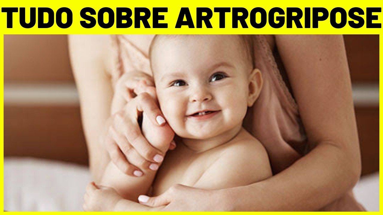 ARTROGRIPOSE - O QUE É, CAUSAS, SINTOMAS E TRATAMENTO - YouTube