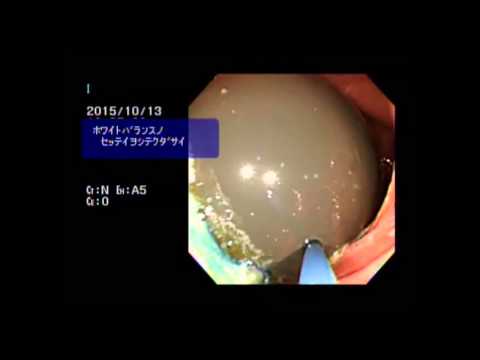 Endoscopic removal of intragastric balloon for obesity - YouTube