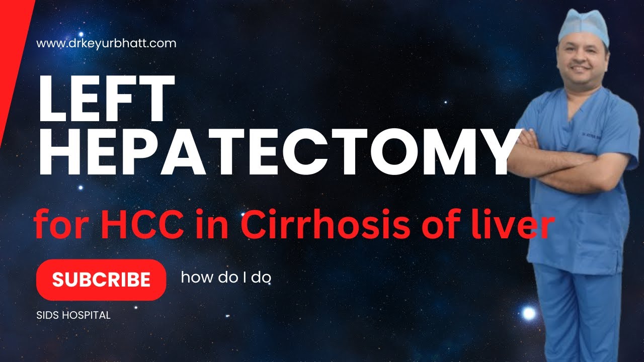Laparoscopic left hepatectomy for HCC | Laparoscopic liver resection ...
