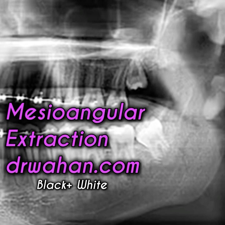 Black + White: Mesioangular Wisdom Tooth Extraction - YouTube