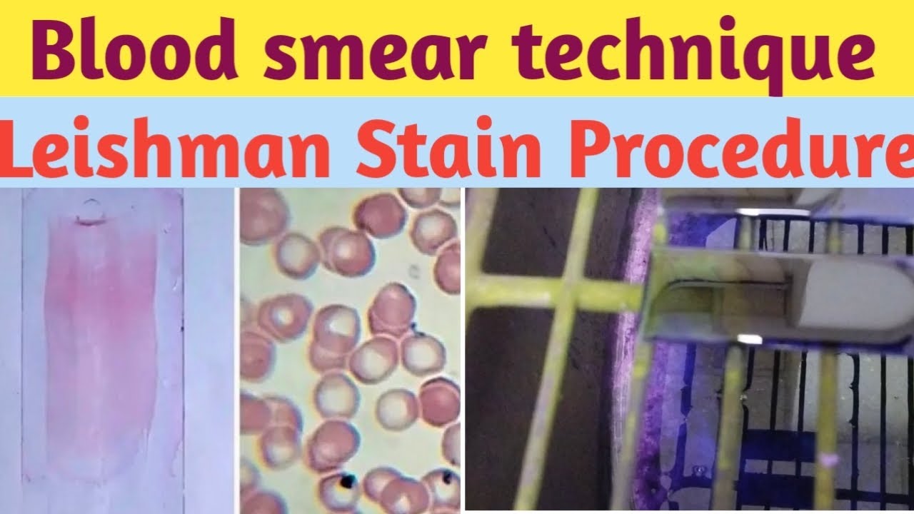 Blood Smear and Leishman's stain l #PATHOGENESIS #PBF | Leishman ...