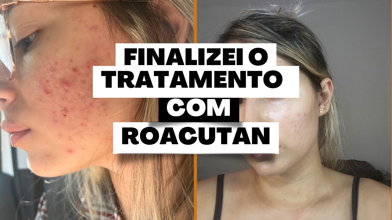Finalizei meu tratamento com Roacutan - YouTube