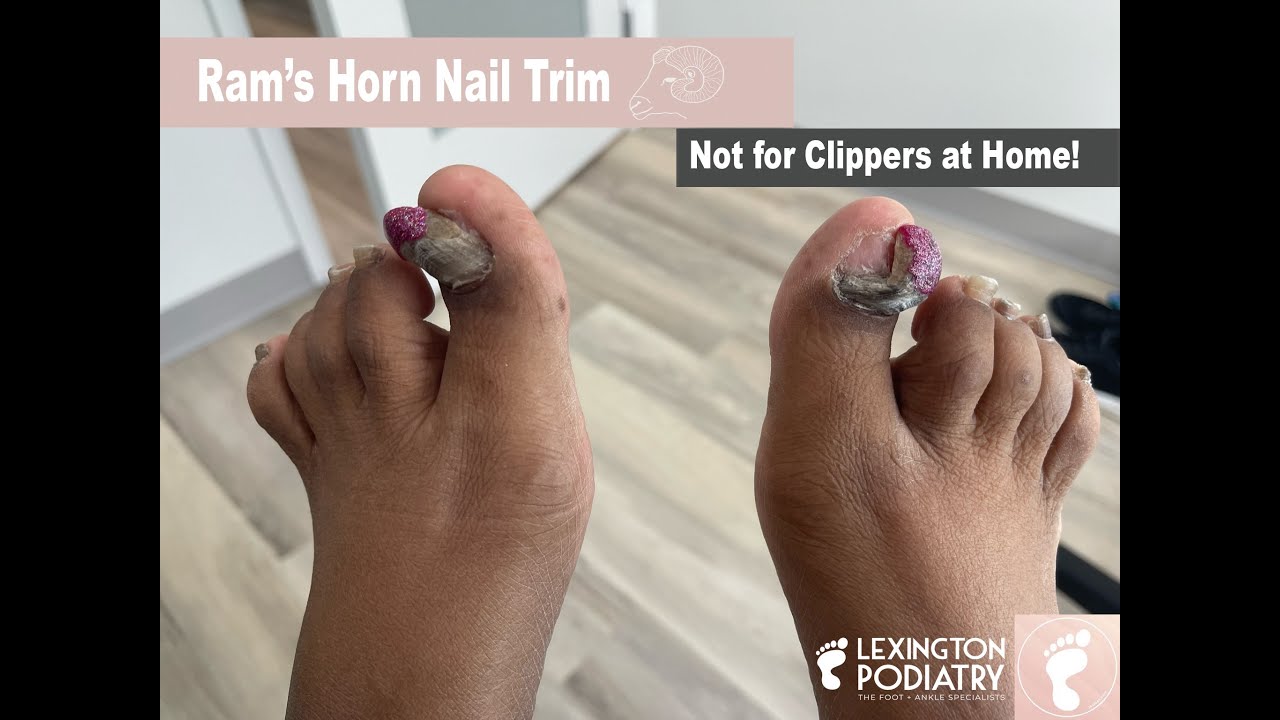 Ram's Horn Nail Transformation - YouTube