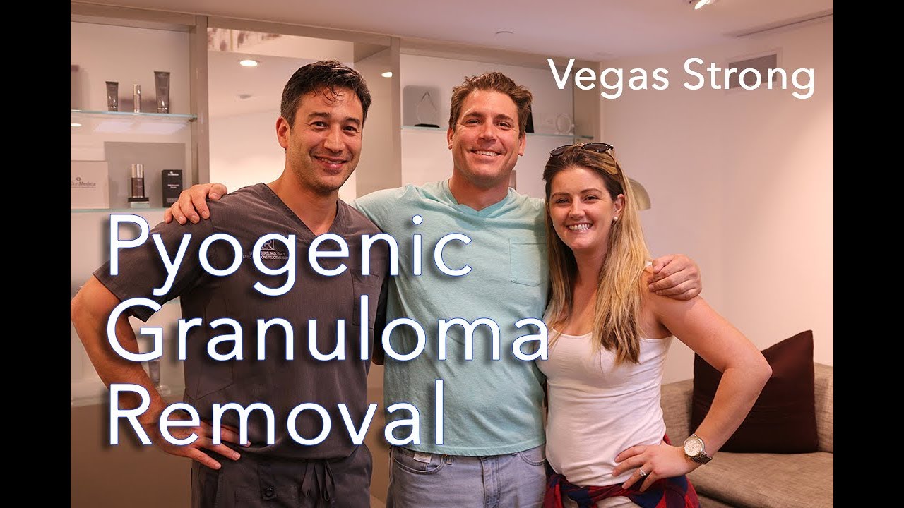 Pyogenic Granuloma Removal From Gun Shot Wound - YouTube