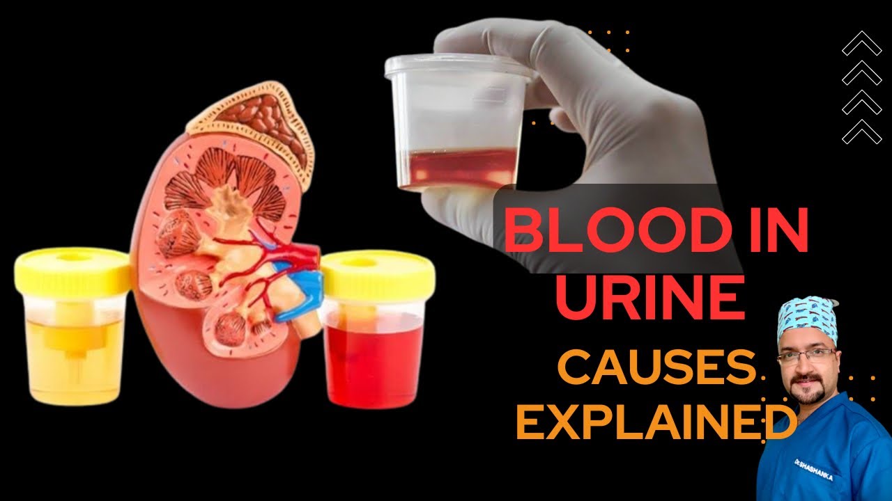 Blood in Urine - Causes explained- simple language- Dr. Dhanuka ...