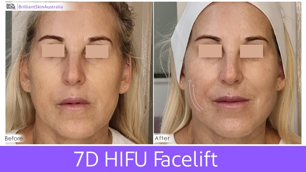 7D HIFU Facelift - YouTube