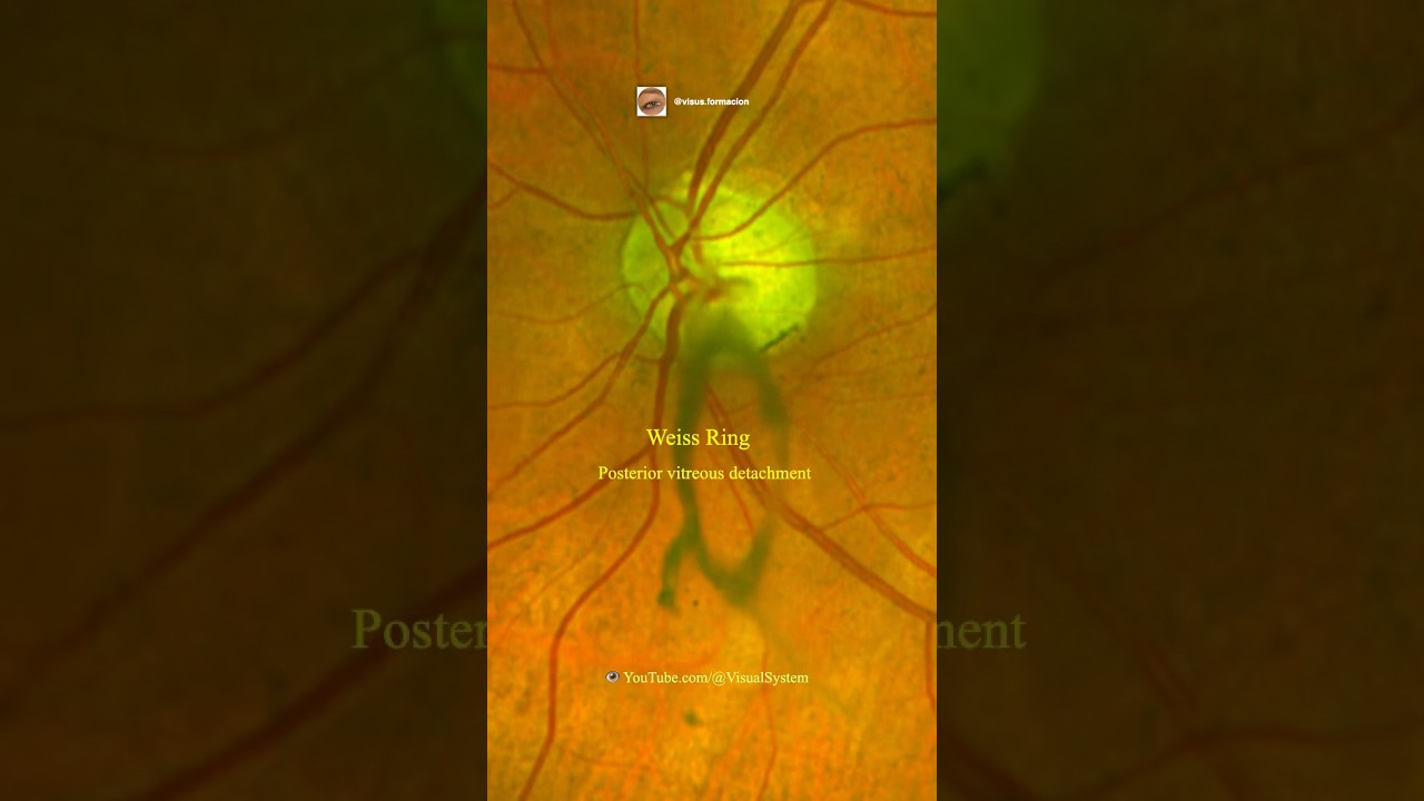 Posterior Vitreous Detachment Weiss Ring