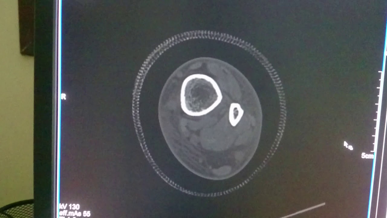 CT scan ankle fracture noted - YouTube