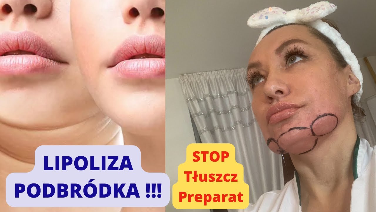 Rozpuszczanie tłuszczyku z drugiego podbródka czyli lipoliza iniekcyjna ...