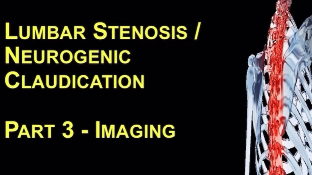 Lumbar Stenosis / Neurogenic Claudication - Imaging - Zeeshan Sardar ...