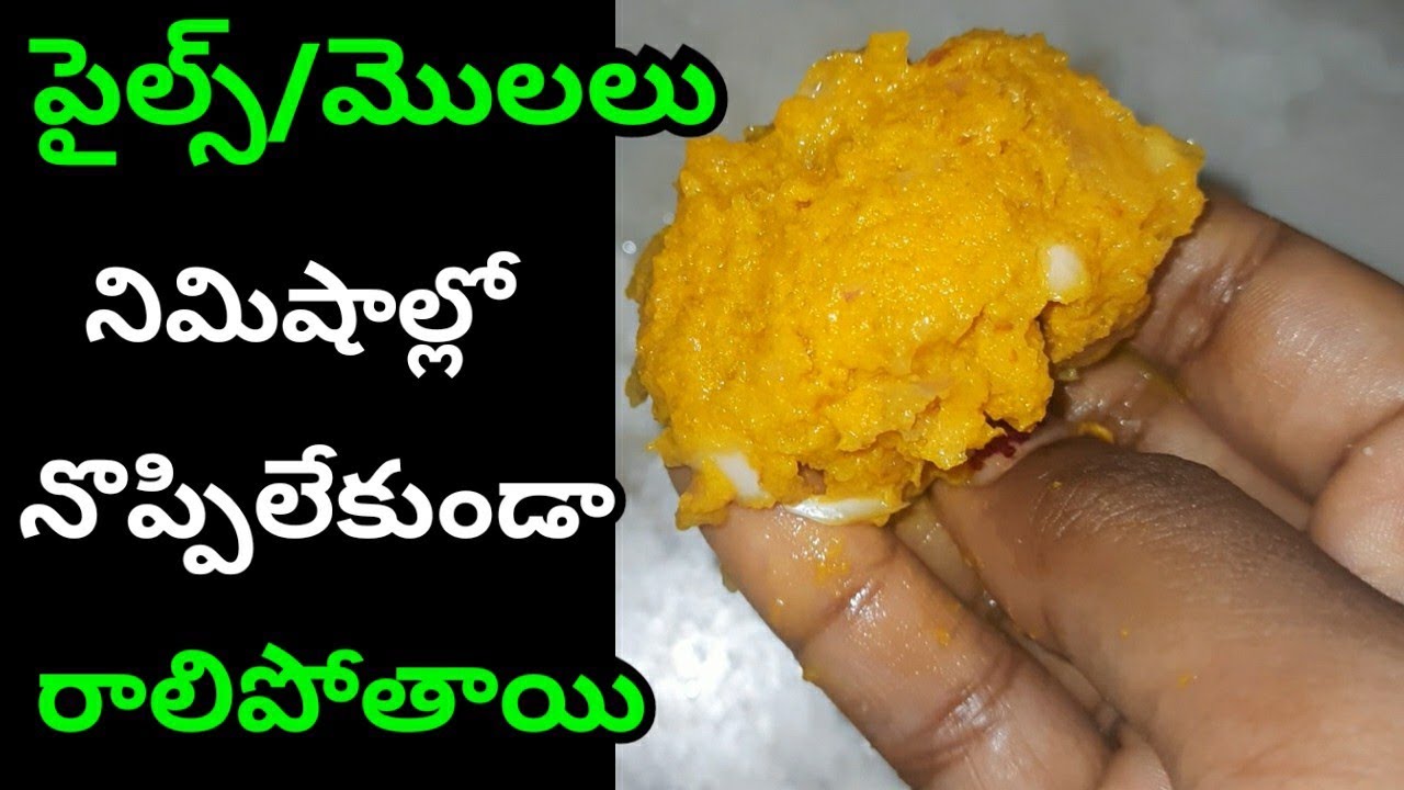 పైల్స్ | మొలలు | Piles | Molalu | How To Cure Piles | Home Remedies For ...