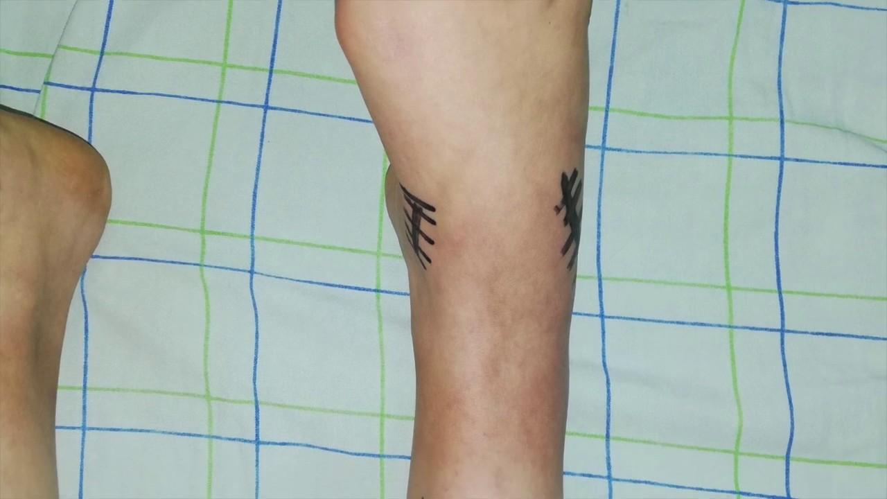 POSTERIOR TIBIAL TENDON TRANSFER (Dr RAFIQI Kamal) - YouTube