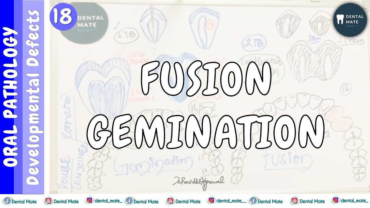 Fusion | Gemination | How to differentiate between fusion and ...