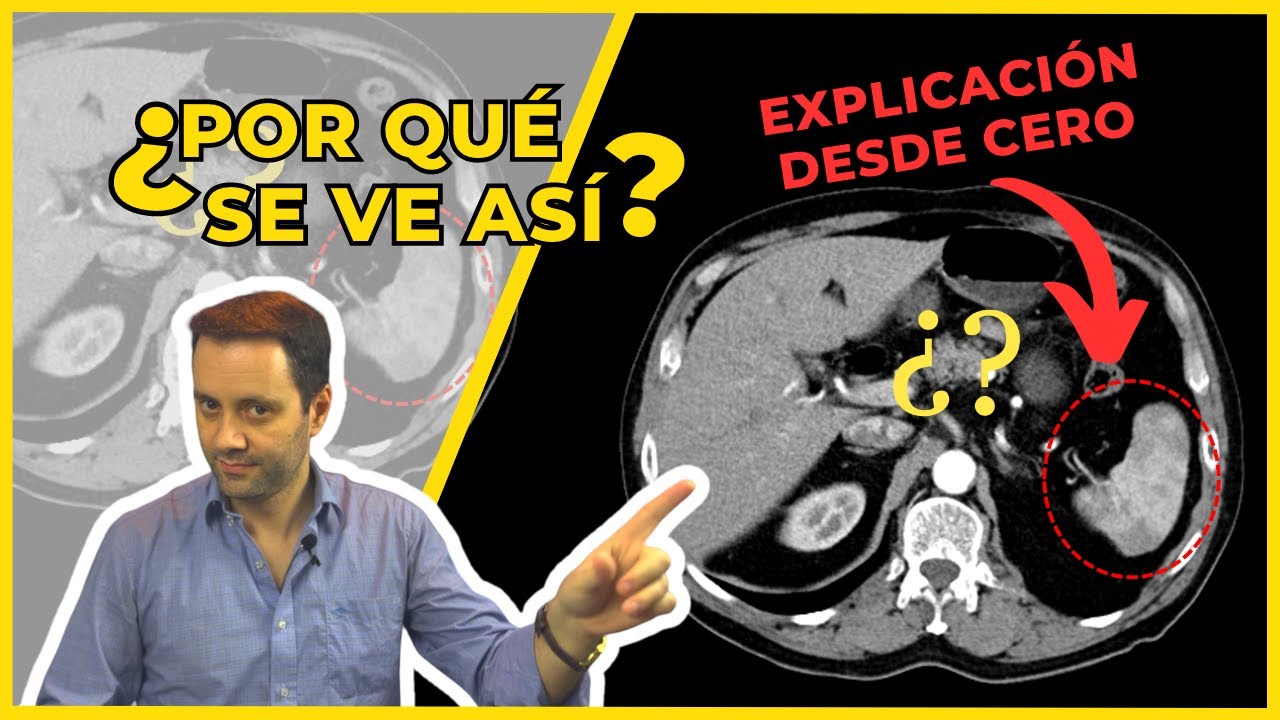 Patrón de realce del bazo | Explicación desde cero - YouTube