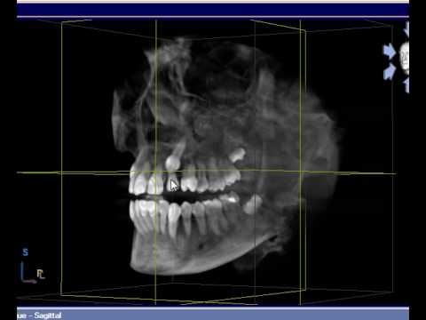 3D View of CBCT - YouTube