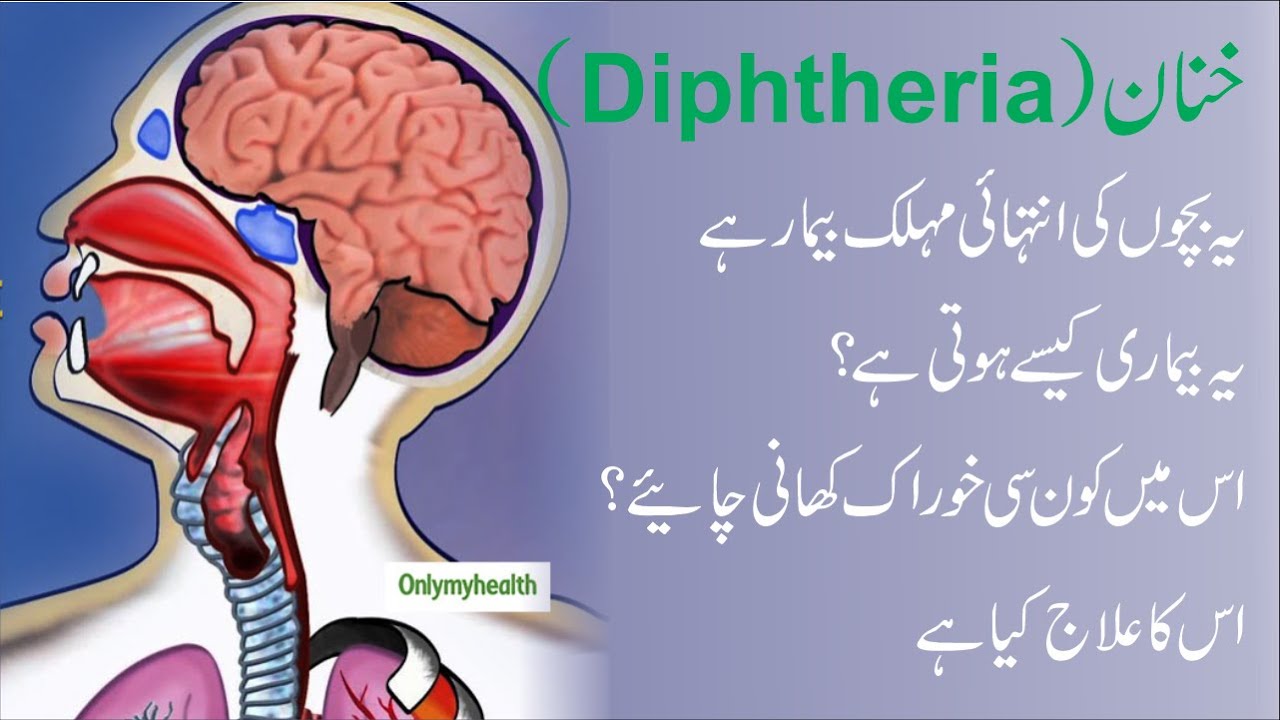 Diphtheria | Health and Disease | Causes, Symptoms & Treatment ...