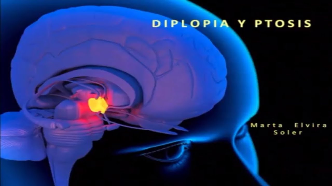 DIPLOPÍA Y PTOSIS - YouTube