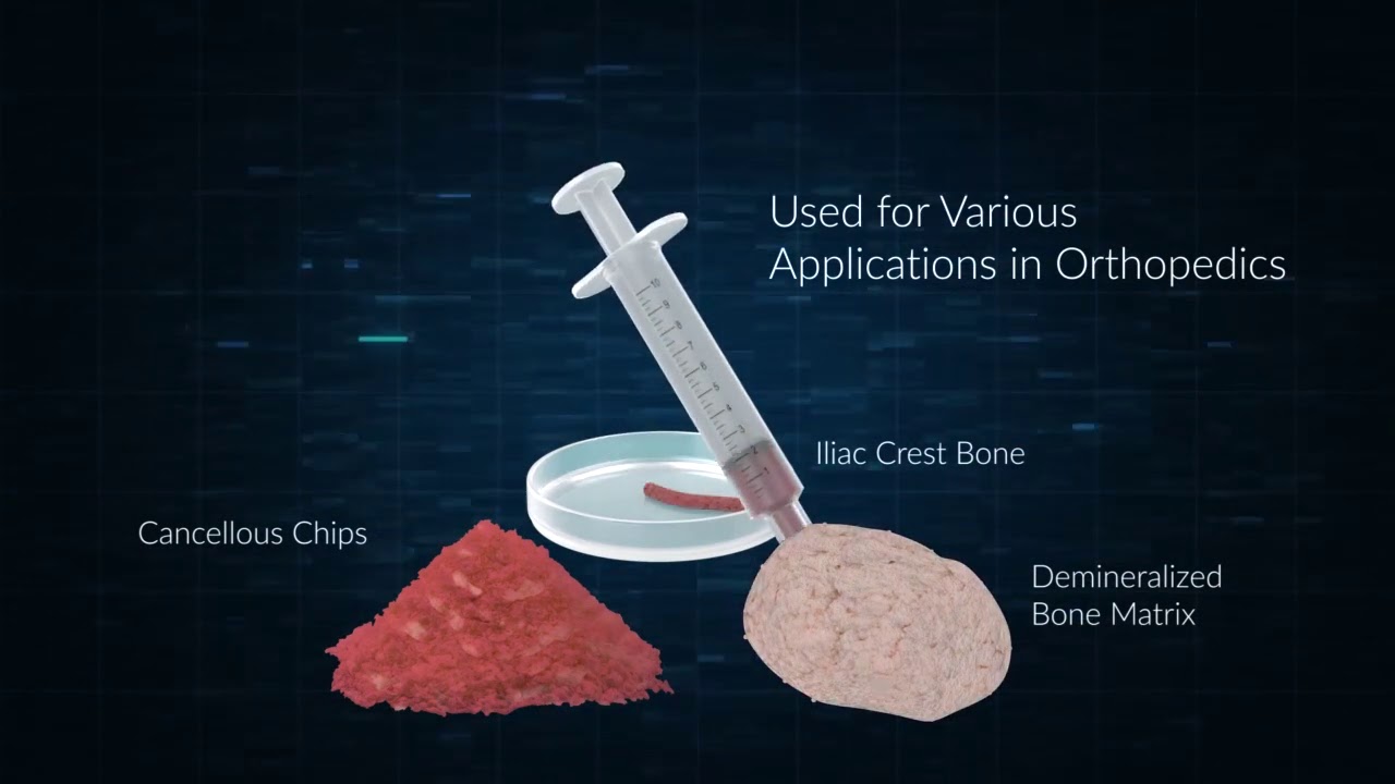 Maxx™ Cell - The World’s MostAdvanced Bone Marrow Extraction Device ...