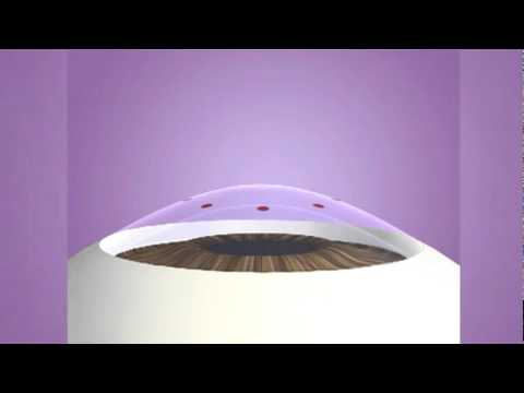 Laser Thermal Keratoplasty (LTK) - YouTube