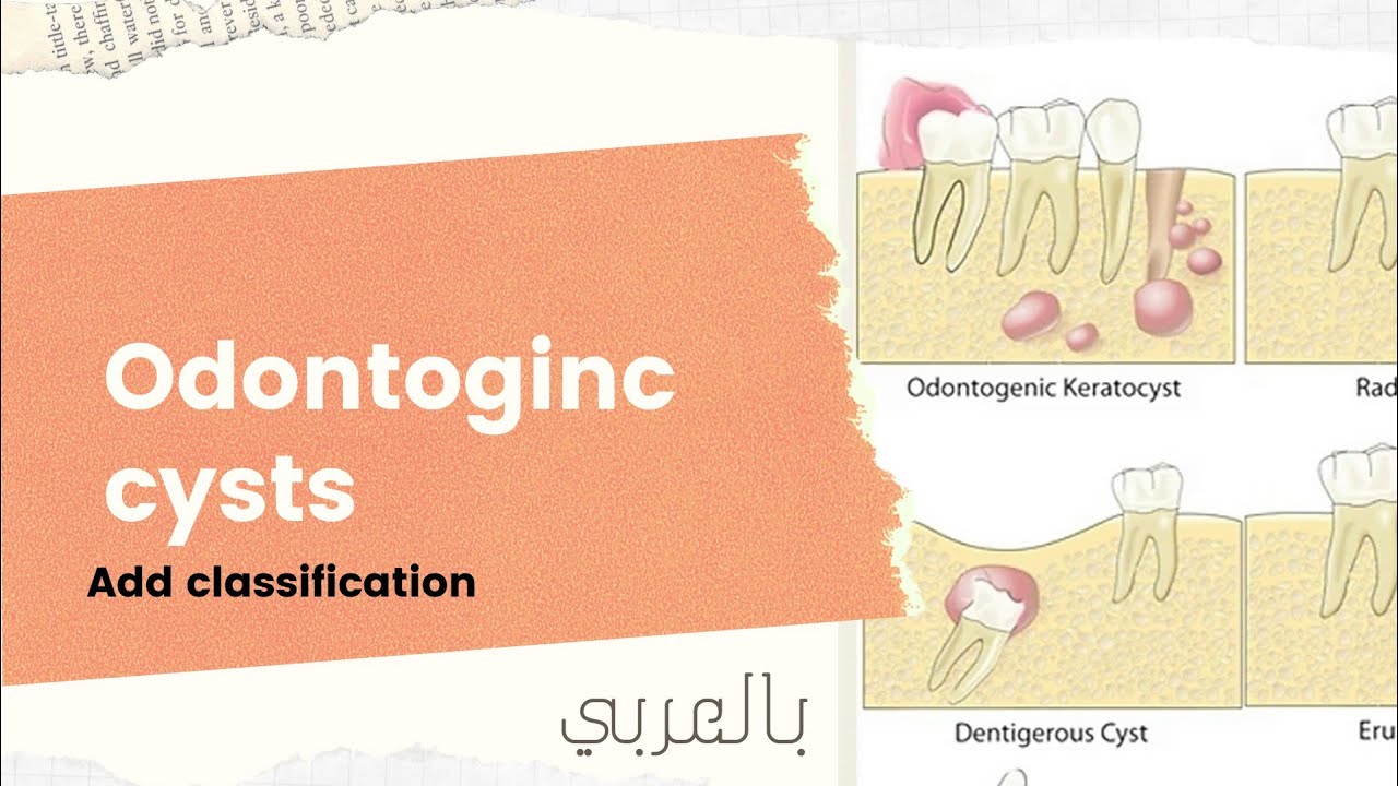 Odontogenic cysts - Pathology | بالعربي - YouTube
